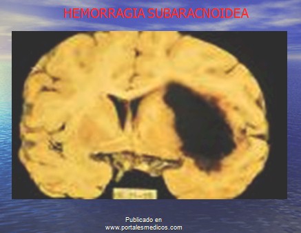 mi primer blog: HEMORRAGIA SUBARACNOIDEA