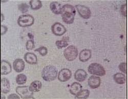 fichero hematologia: talasemia