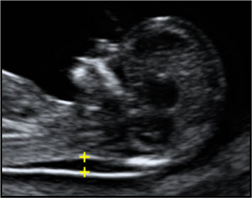 Baby 3D 4D Scan: NT Scan