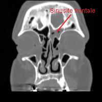 Nouveau traitement de la sinusite : Le ballonnet de dilatation des ...