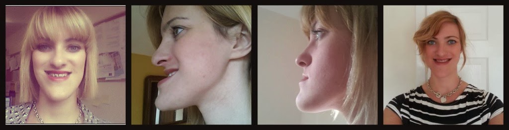 A Wimps Guide to Orthognathic Surgery: Double Jaw Surgery Results ...
