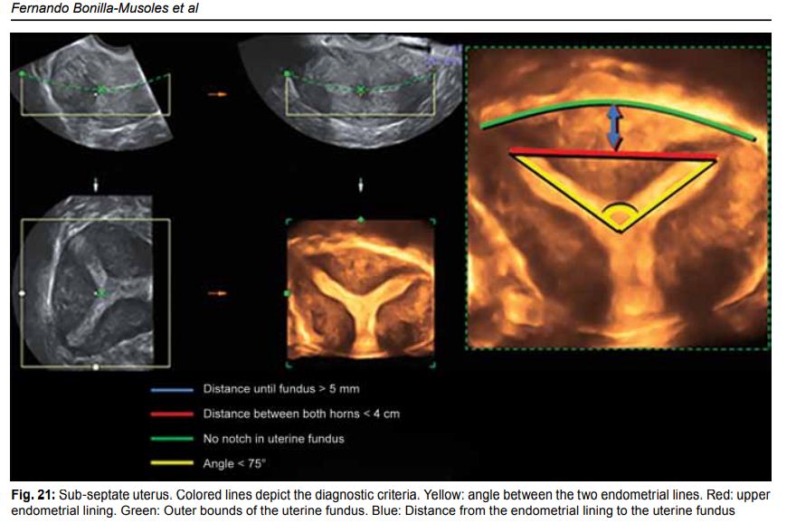 Nagendra's Radiology Blog: SEPTATE AND ARCUATE UTERUS ----PICTORIAL ...