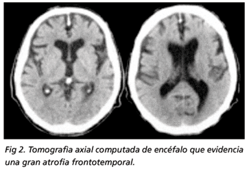 Cuidados del anciano: DEMENCIA FRONTO-TEMPORAL