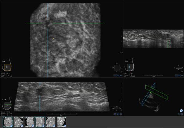 Enfoque Radiologico: El sistema automatizado de ultrasonido de mama ...