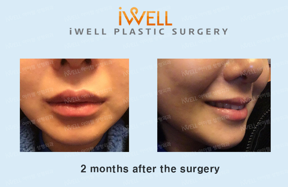 [Real Review] Lifting the drooping corner of lips - iWELL plastic surgery