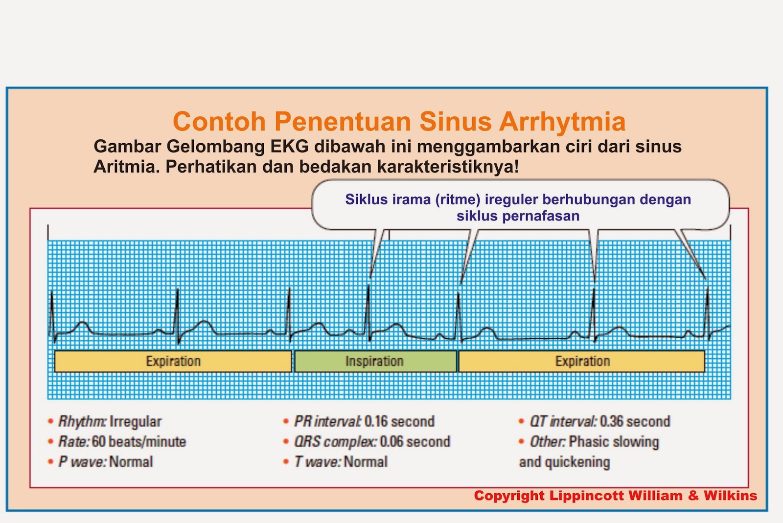 Sinus Node Arhytmia