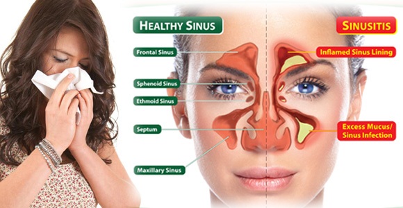 Sinusitis (Rinosinusitis) ~ Panduan Praktik Klinis Bagi Dokter