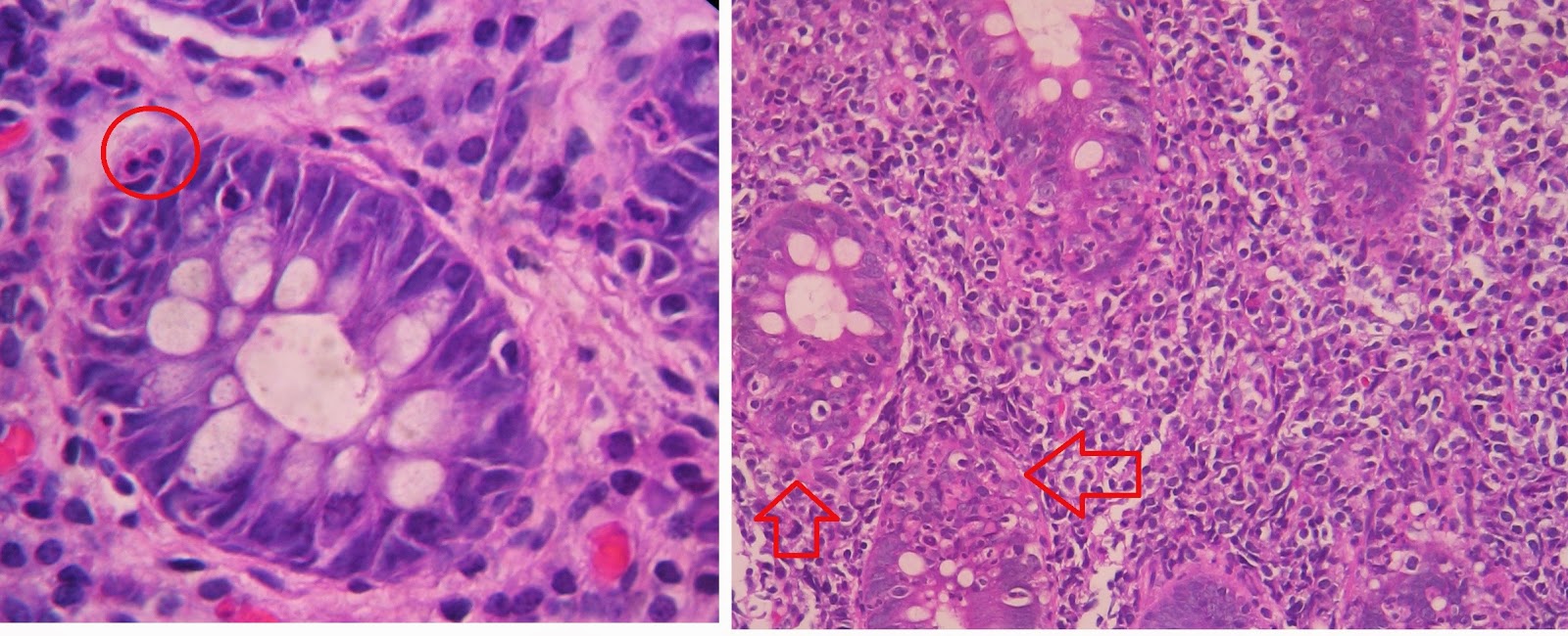 GASTROINTESTINAL AND LIVER HISTOLOGY PATHOLOGY ATLAS: COLON: INFECTIOUS ...