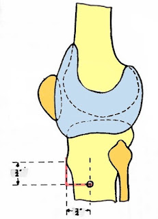Skeletal Traction: Common sites