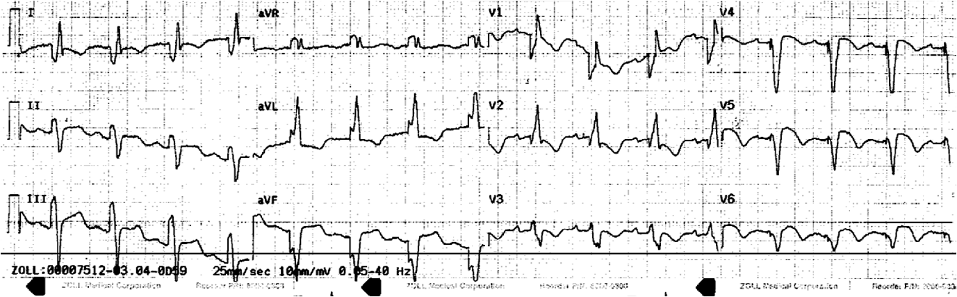 Dr. Smith's ECG Blog: Paced Rhythm with Dynamic ST segments and ...