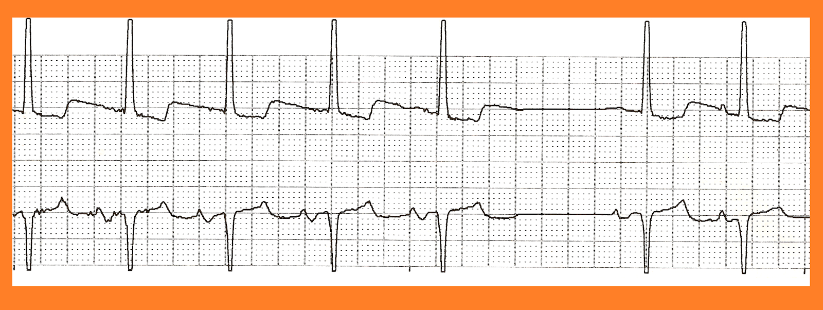 EKG Rhythm Quiz 245