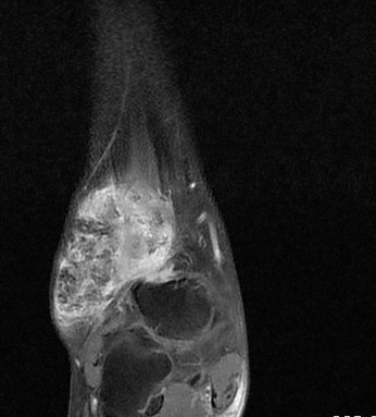 Pigmented Villonodular Synovitis Ankle - Sumer's Radiology Blog