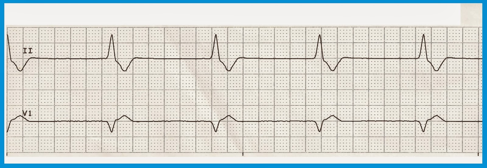 Practice EKG Rhythm Strips 219