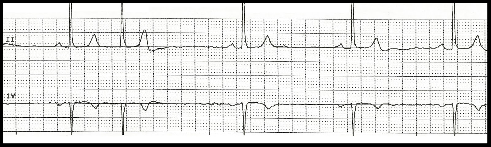 Basic EKG Rhythm Test 11