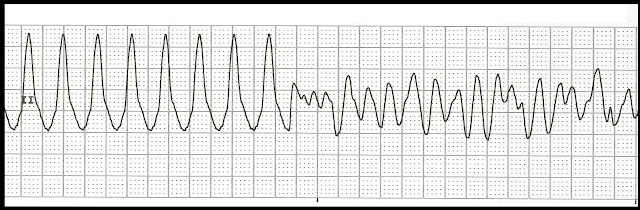 Monomorphic Ventricular Tachycardia