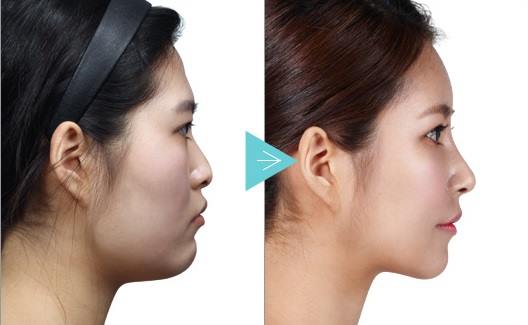 TL PLASTIC SURGERY CLINIC KOREA: No more flat&sunken forehead!! TL ...