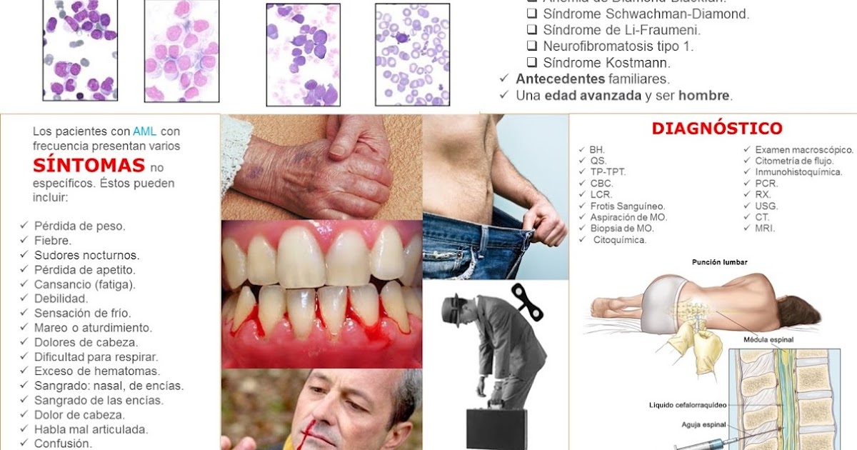 DIVULGACIÓN CIENTÍFICA UG: Leucemia Mieloide Aguda DIVULGACIÓN CIENTÍFICA UG: Leucemia Mieloide Aguda