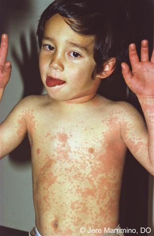 Have you heard about Kawasaki Disease?