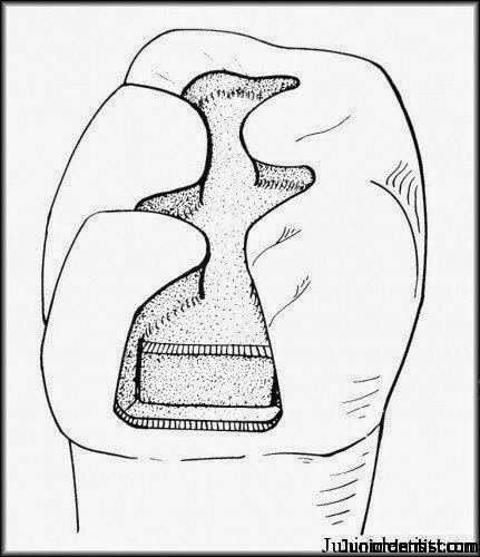 DenTodaY: Retention Form In Cavity Preparation