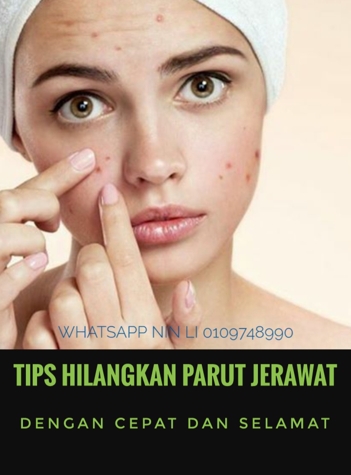 Kesihatan Keutamaan Kita: Tips Hilangkan Parut Jerawat Dengan Cepat Dan ...