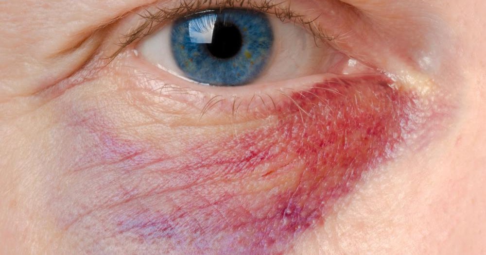 health: the way to Relieve allergies and Allergic Shiners