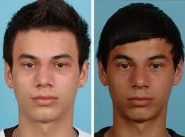 Medical Treatment Pictures-for Better Understanding: Septoplasty ...