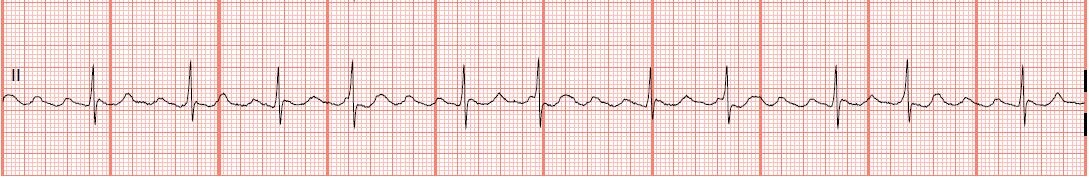 ECG Rhythm Strip Quiz 69