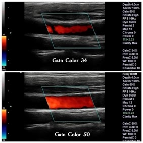 Color Doppler Ultrasound ( USG Berwarna)