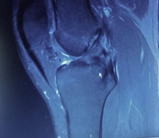 PCL Reconstruction-MRI - Radiology Imaging