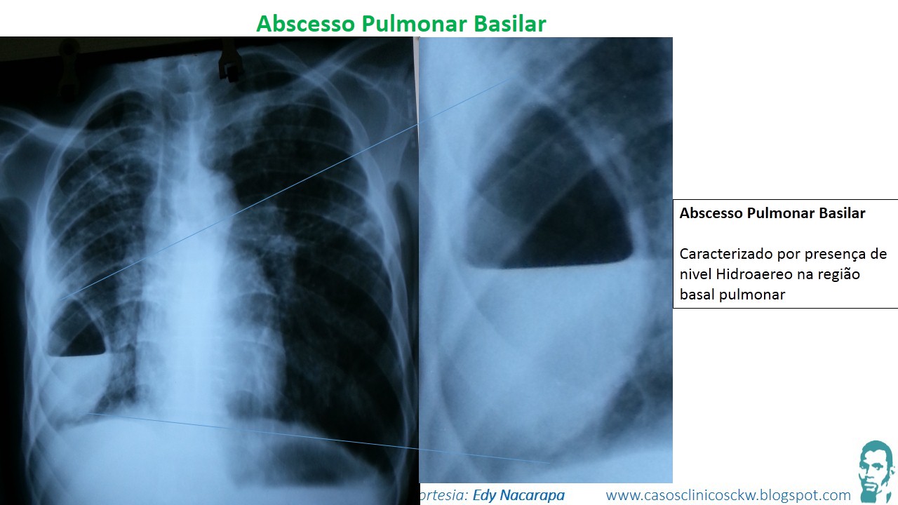O Que é Abscesso Pulmonar - RETOEDU