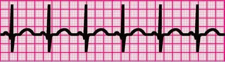 Normal Sinus Rhythm ~ Nursing