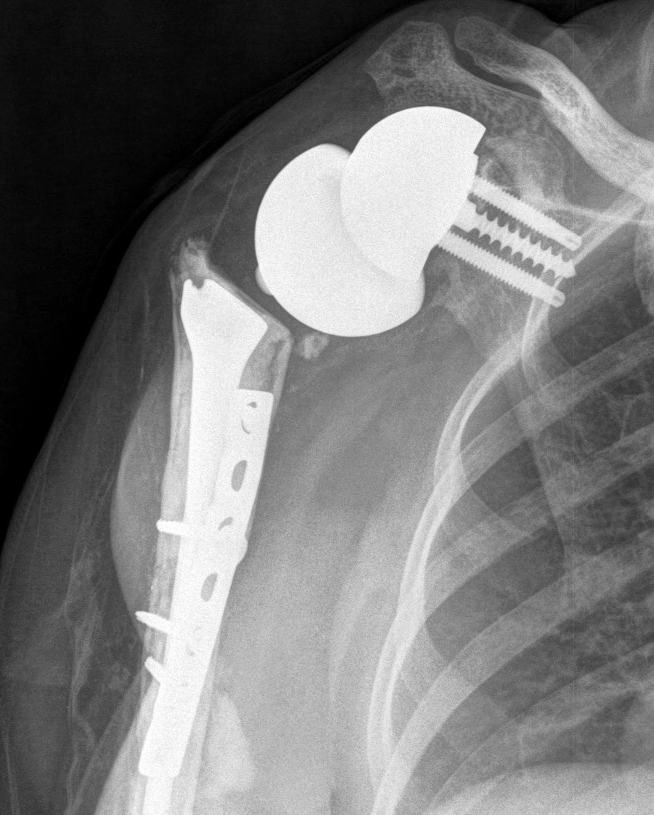 UW Shoulder and Elbow Academy: Reverse total shoulder - choosing a ...