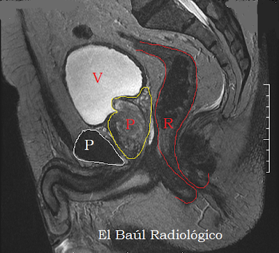 El Baúl Radiológico: ESPECTROSCOPIA PROSTÁTICA MEDIANTE RESONANCIA ...