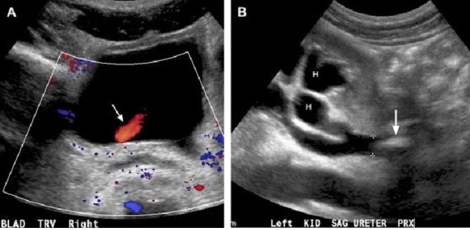 Renal Ultrasound Cases (Adrenal haemorrhage, Perinephric haematoma ...