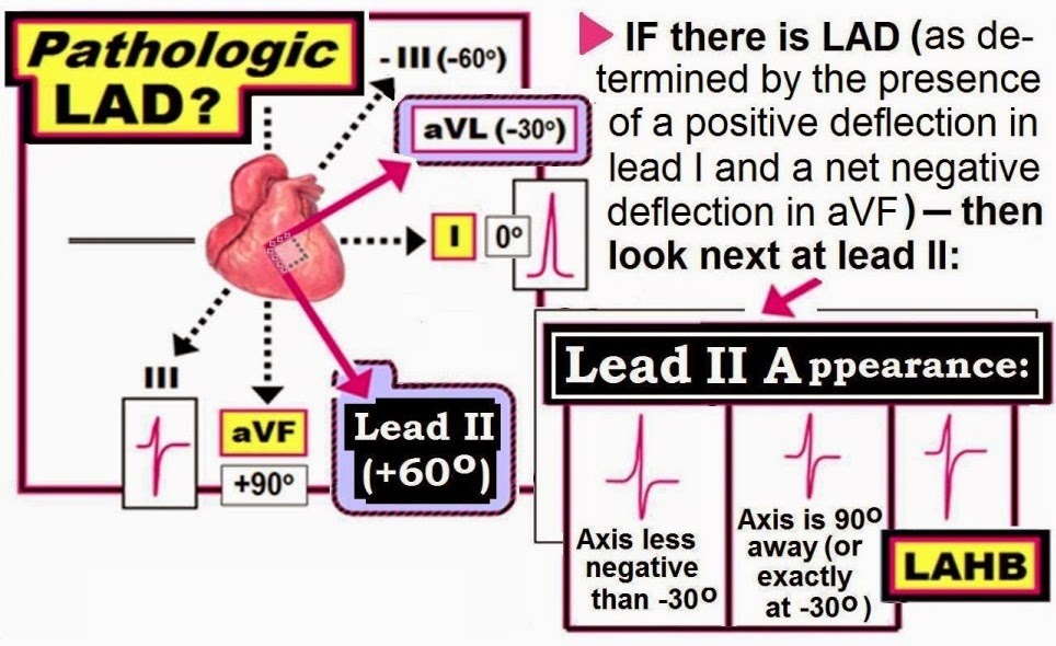 Hemifascicular Block, Hemiblock, LAHB : 네이버 블로그