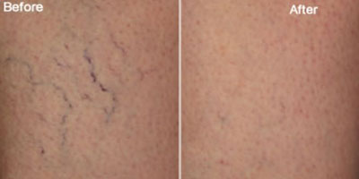 Selston Cosmetic Clinic: Laser Treatment for Spider Leg Veins ...