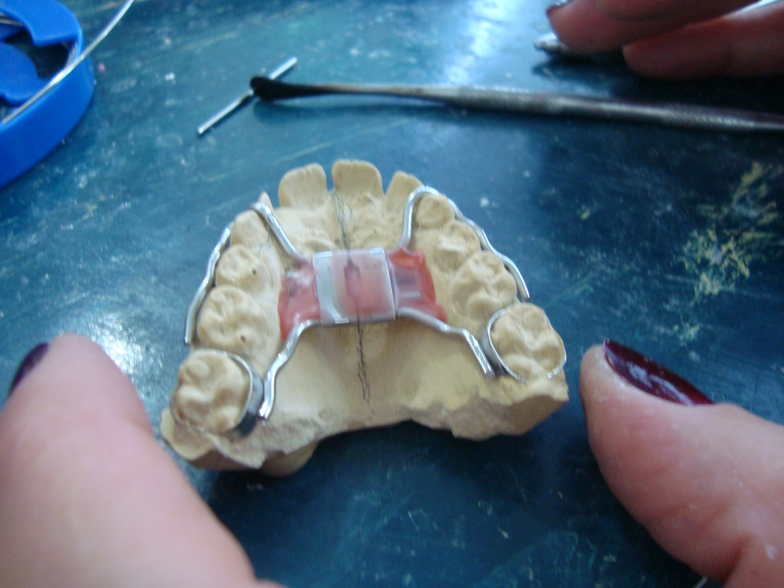 Laboratório Ortodôntico Bohrer: CONFECÇÃO DE HYRAX