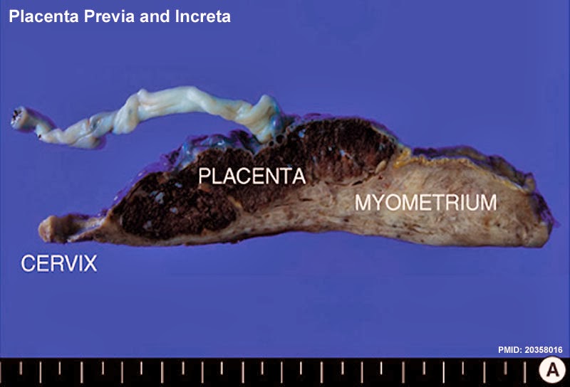 Embriología ENMH: Placenta Patologías