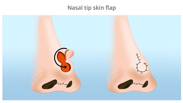 Best nose job clinic in Korea: Nose tip reconstruction using nasal tip ...