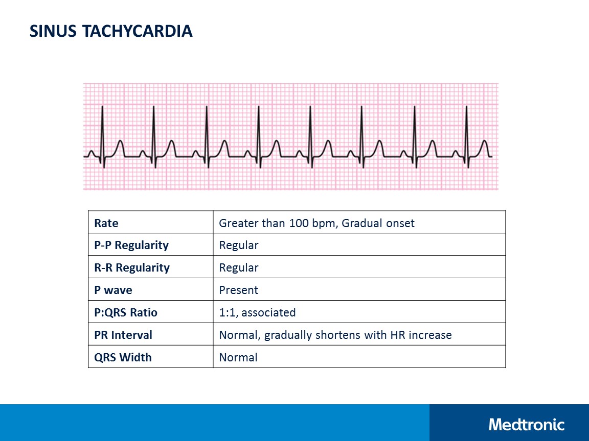 CVT Mohd Farid: Heart Rhythm Interpretation Part I-Medtronic Academy