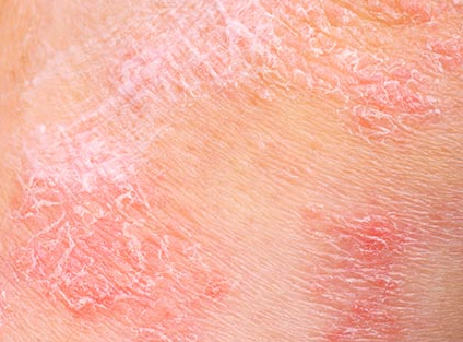 Si padeces de Dermatitis Atópica Aguda (Grave), tu vida puede cambiar ...