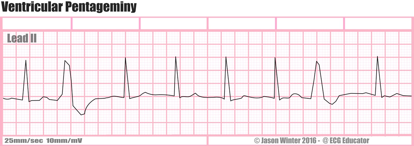 ECG Educator Blog : Six Second ECG Rhythm Strips