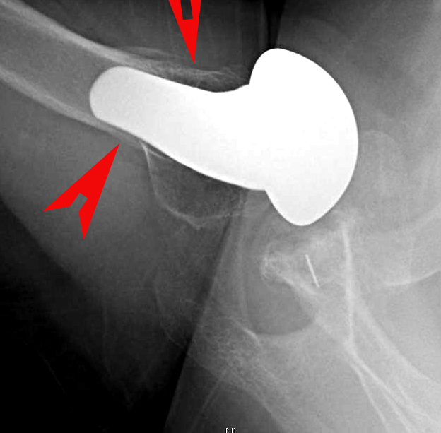 Shoulder Arthritis / Rotator Cuff Tears / Shoulder Pain : Short humeral ...