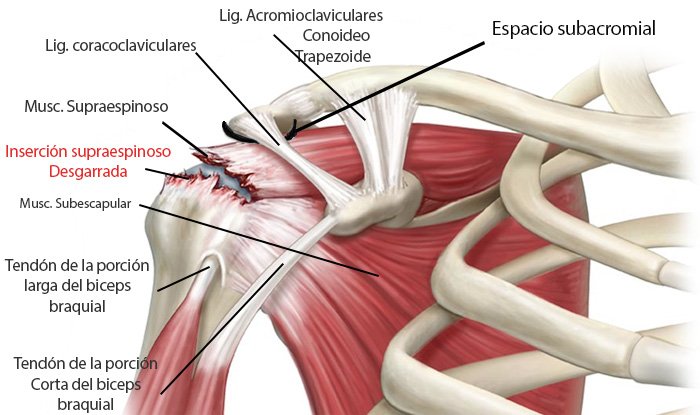 Rehabilitación: TENDINITIS DEL SUPRAESPINOSO