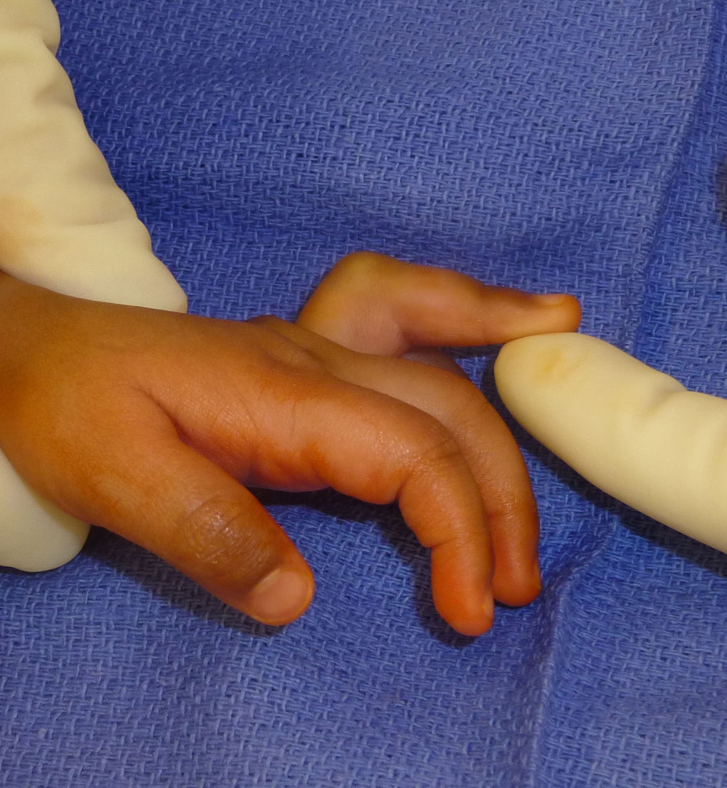 Camptodactyly, Unusual Cause | Congenital Hand and Arm Differences ...