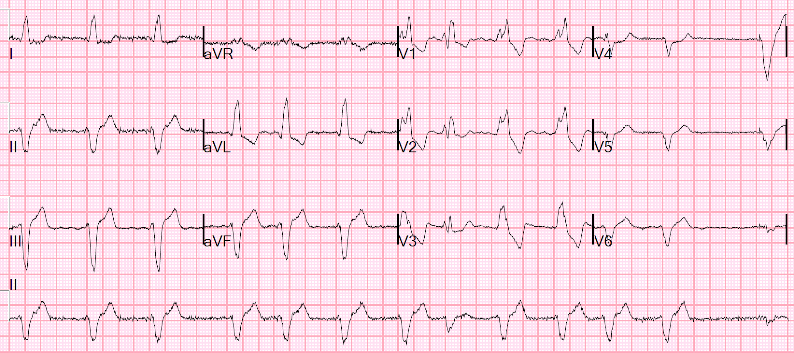Dr. Smith's ECG Blog: Chest pain and Concordant ST Depression in a ...