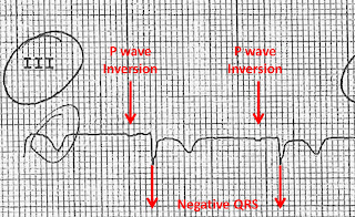 ECG of the Week: ECG of the Week - 18th March 2013 - Interpretation