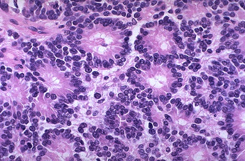 Flexner–Wintersteiner rosette