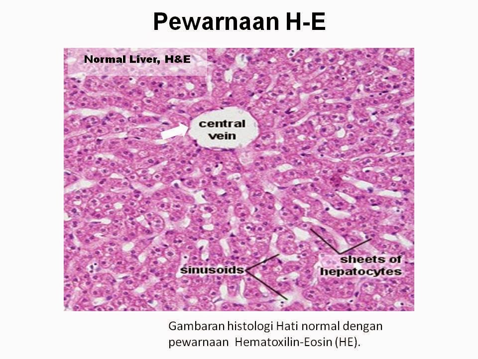 Reza Aditya Digambiro: BIOPSI HATI PADA HEPATITIS KRONIK