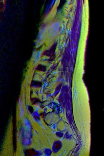 Nevit's blog: Color MRI of spine